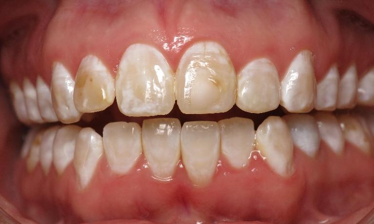 Lake Charles LA Dentist | Smile Gallery | Our Before & After Cases